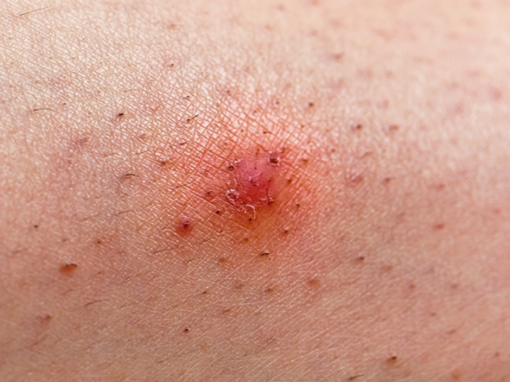 How to Remove an Ingrown Hair | Step-by-Step Guide